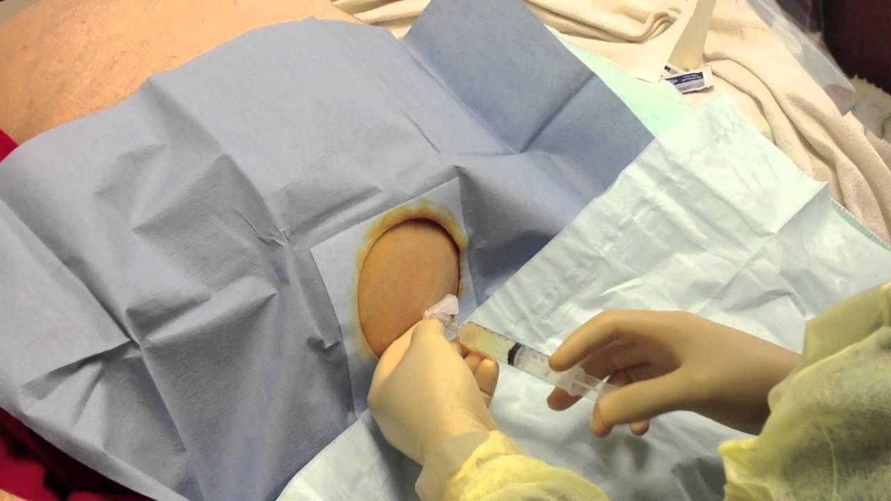 Paracentesis – POCUS Pro and Proceduralist.org